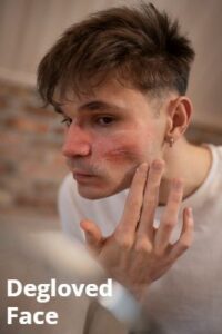 Degloved Face - Radar Magazine